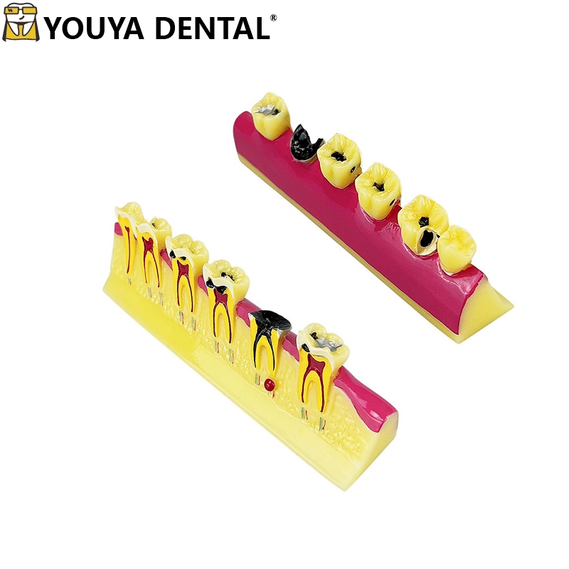Dental caries classify Tooth Model of pathological process around teeth ...