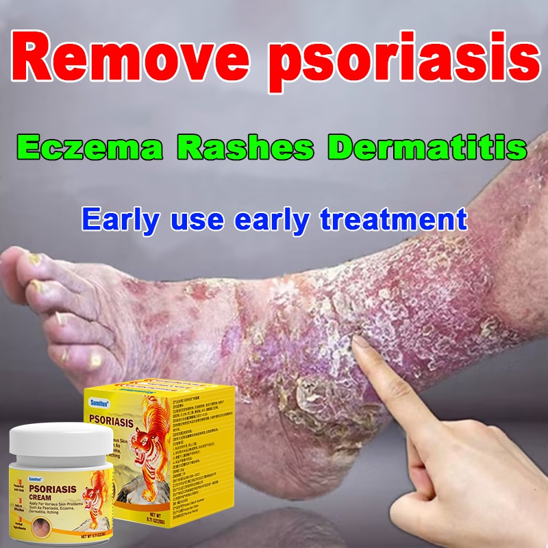 Psoriasis Cream eczema antifungal cream cure psoriasis rashes tinea ...