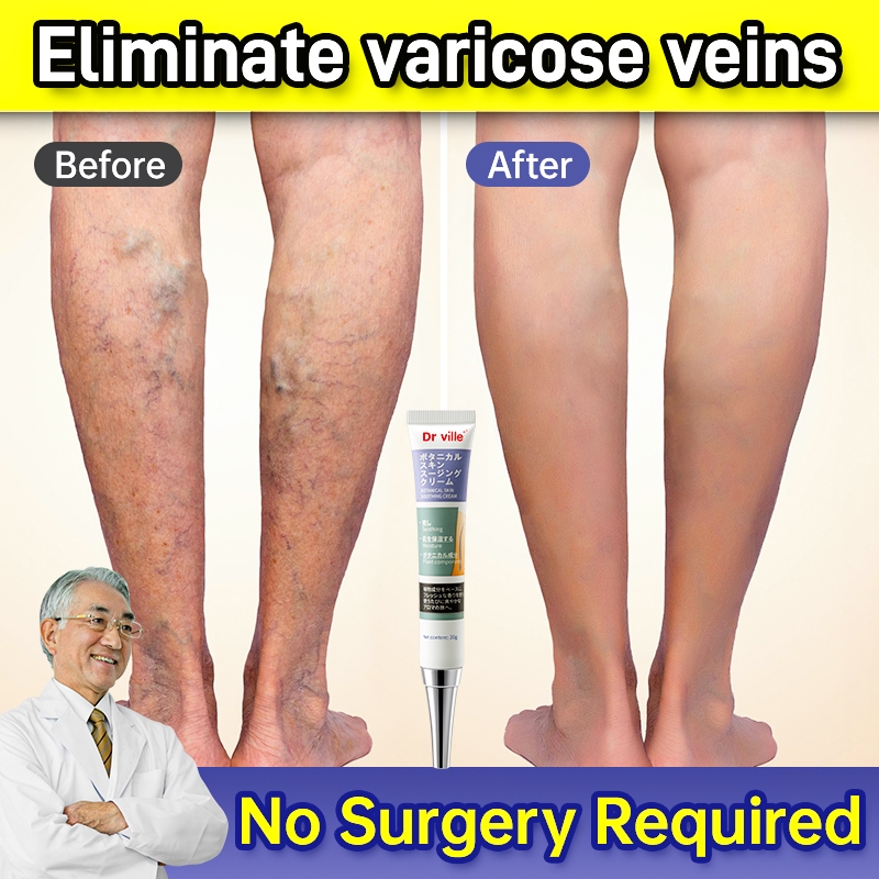 Dr.ville Varicose Veins Cream Effective Removal Varacous Vein Spider ...