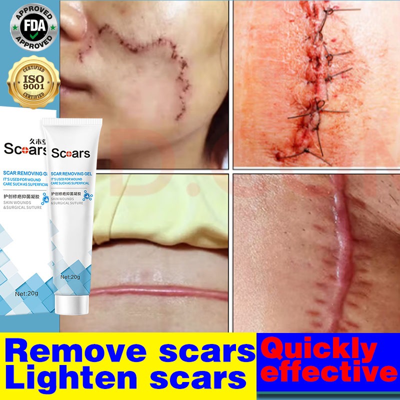 Scar cream scar removal cream 30ml repair stretch marks scald burns ...