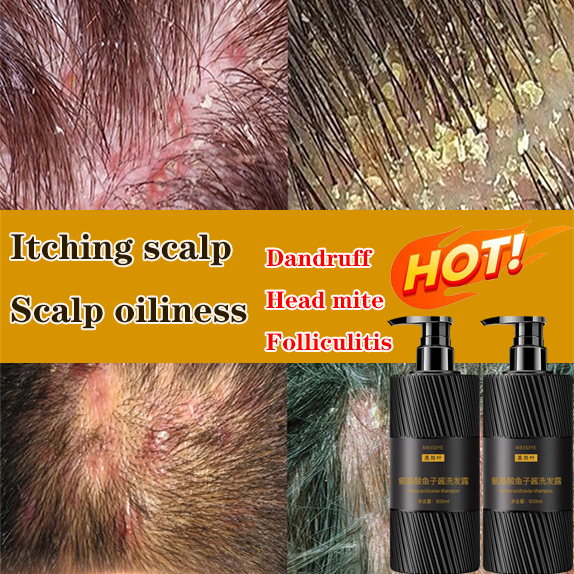 Anti dandruff and anti itch shampoo, dandruff, oil control, mite removal, fluffy and smooth hair ...