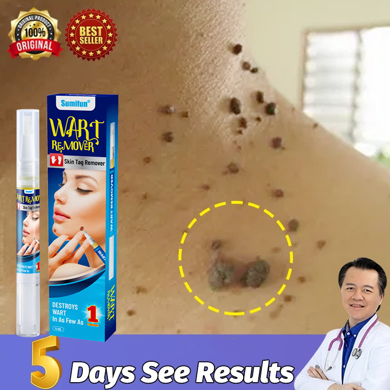 Remover wart removal liquid pen Skin Tag Moles Cholesterol Seed Warts ...
