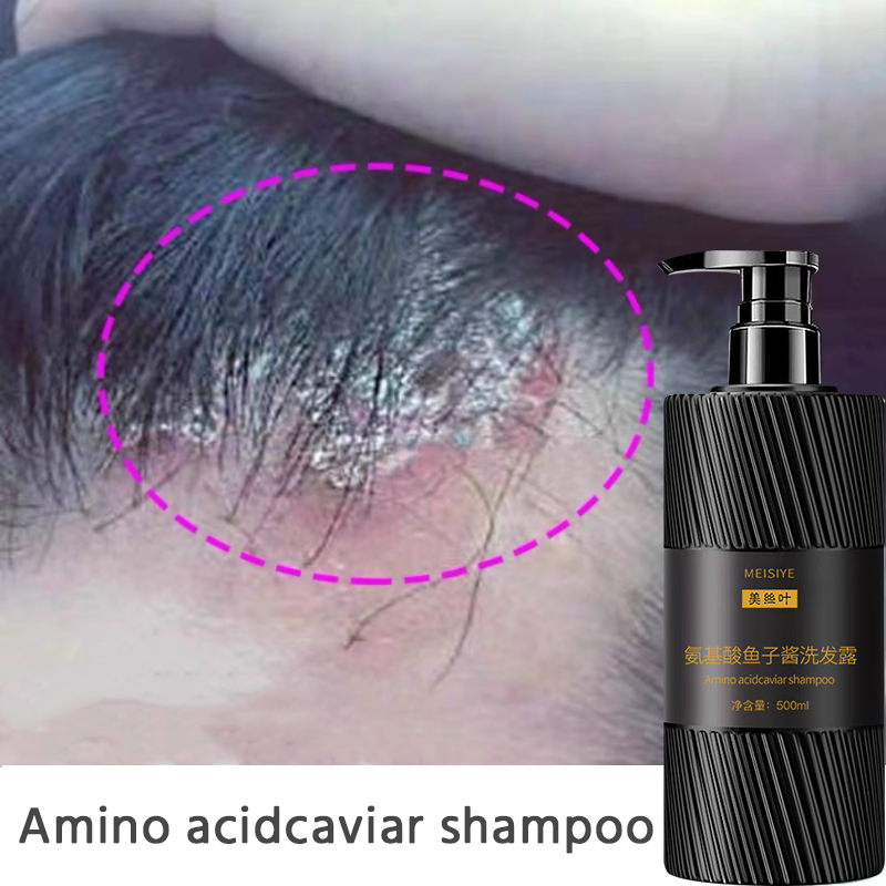 [SG] Shampoo Dandruff Shampoo Anti Itchy Scalp Hair Loss Control Shampoo 500ml Antipruritic ...