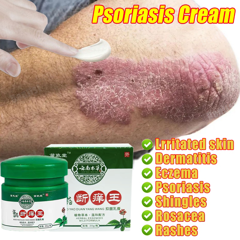 [20g] Skin allergy dermatitis eczema cream skin allergy dermatitis ...