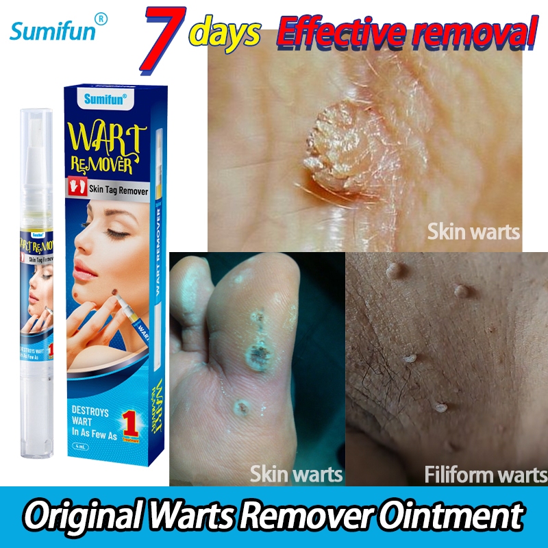 Warts Mole Remover Serum Pen Natural Health Wart Skin Tag Foot Corn ...