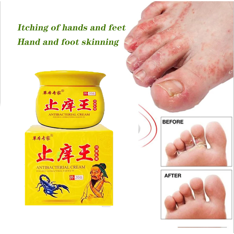 【20g】止痒王 Anti-itch cream Psoriasis Cream Eczema Itchy 草本专家 Itchy feet ...