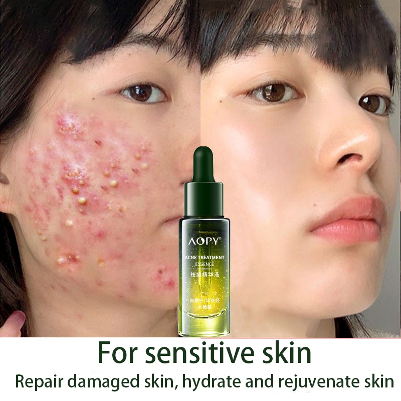 pimple serum Acne scar Acne spot treatment 30ml acne removal serum ...