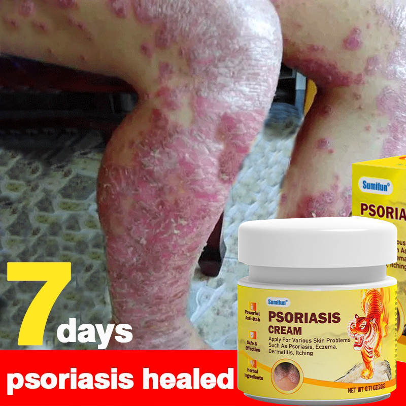 psoriasis cream eczema herbal cream anti itch cream 20g Antibacterial ...