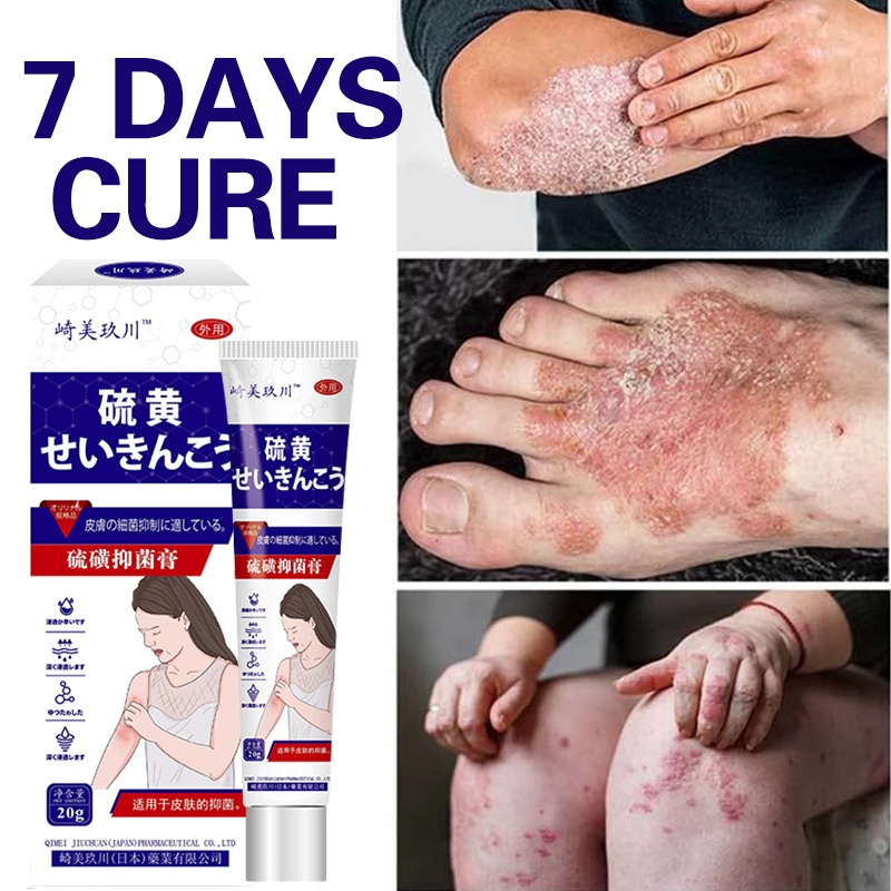 Japan itching cream eczema cream 20g antifungal for redness allergy Itchy skin sulfur private ...