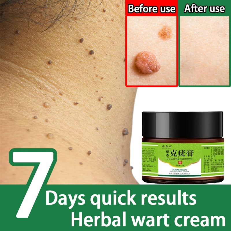 Skin Tags Mole Remover Warts Remover Cream Corn Removal 20g mole ...