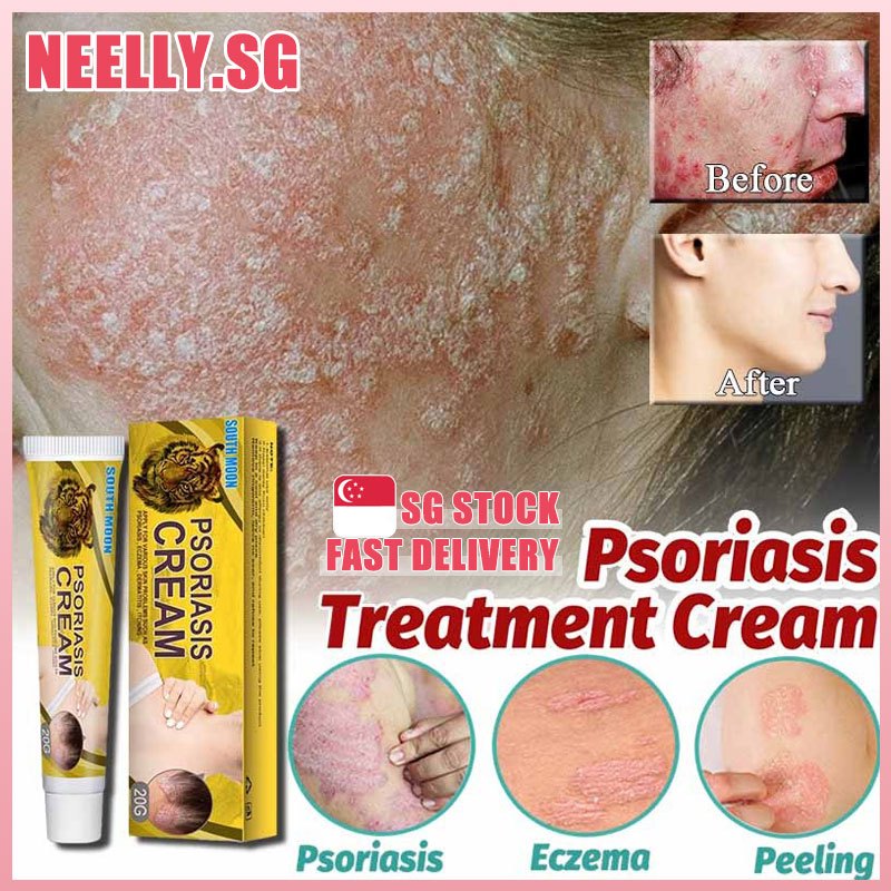 💋𝗦𝗚 𝗦𝗧𝗢𝗖𝗞💋 Herbal Psoriasis ointment Eczema cream Antibacterial anti ...