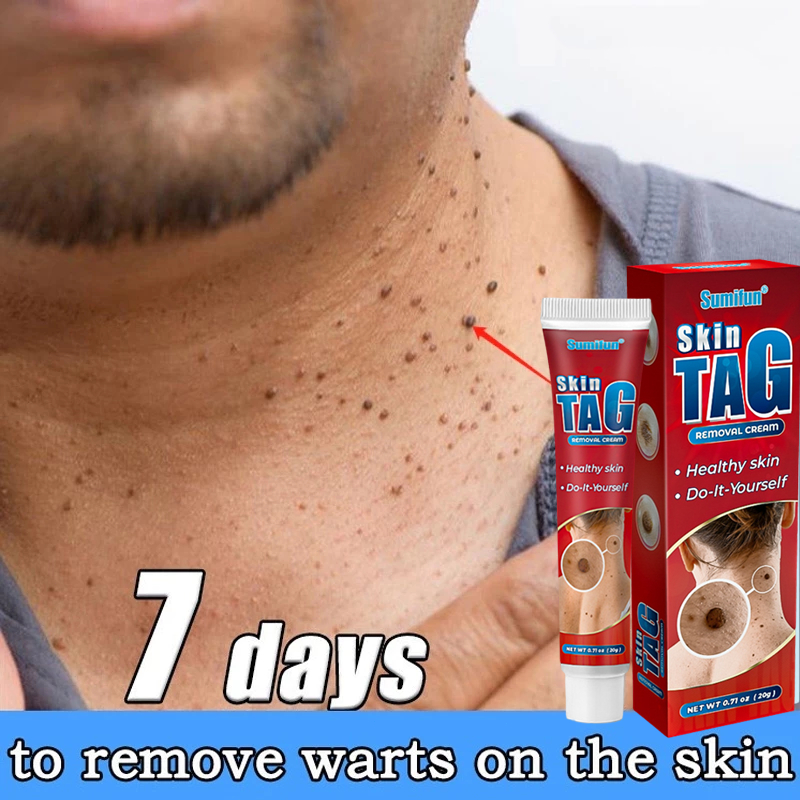 Mole remover Skin tag remover Remove moles and warts Remove cholesterol ...