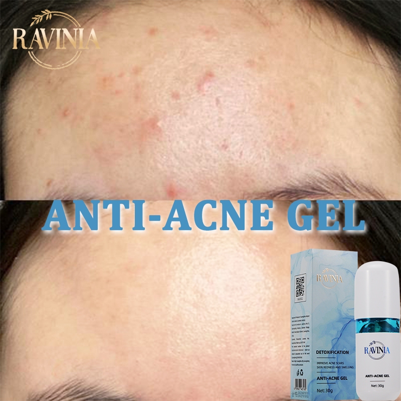 RAVINIA Acne Advance Gel Facial Acnes Removal 30g Eradicating Acnes and Pimples Refresh Skin ...