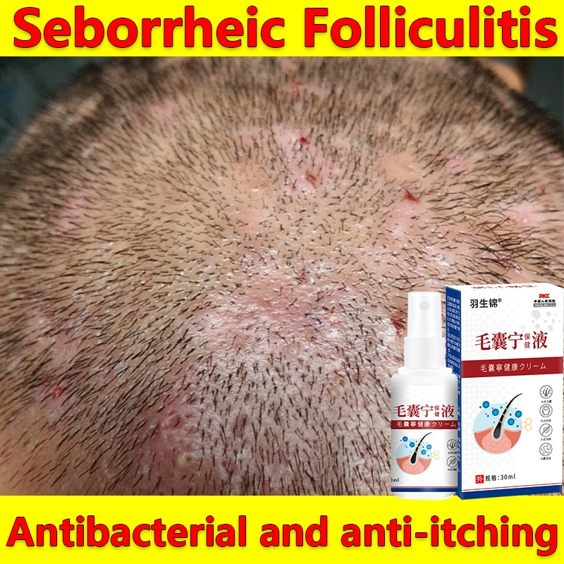 Seborrheic Folliculitis 30ml Relief Scalp Folliculitis Red and Swollen ...