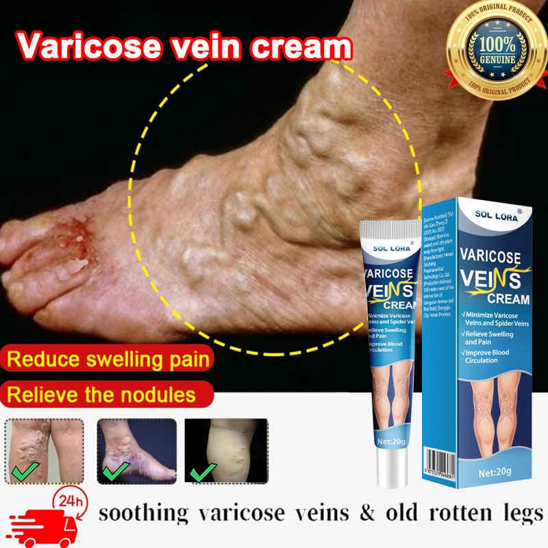 Vein Cream 20g varicose veins cream varicose veins relief cream ...