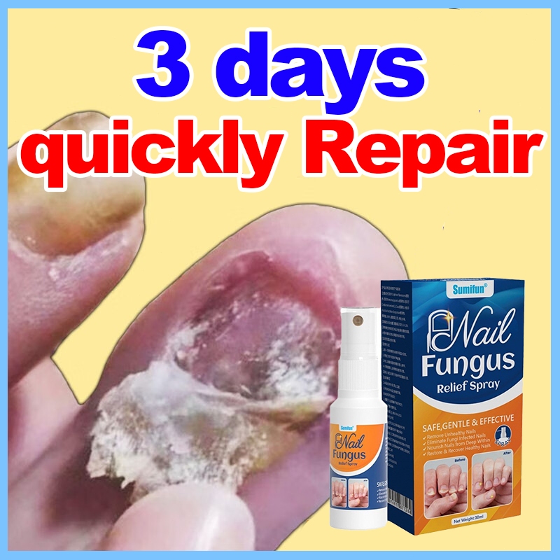 【SG stock】Effective Fungus Removal Anti-Fungal Foot nail fungus nail ...