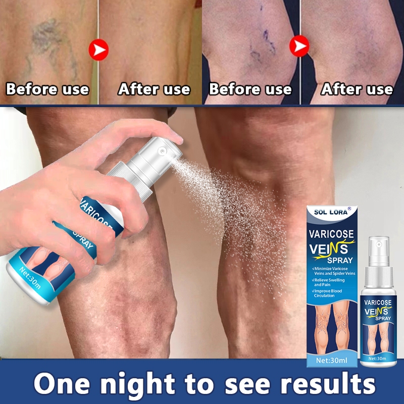 Muscle varicose ointment + spray, repair leg blood vessel swelling ...