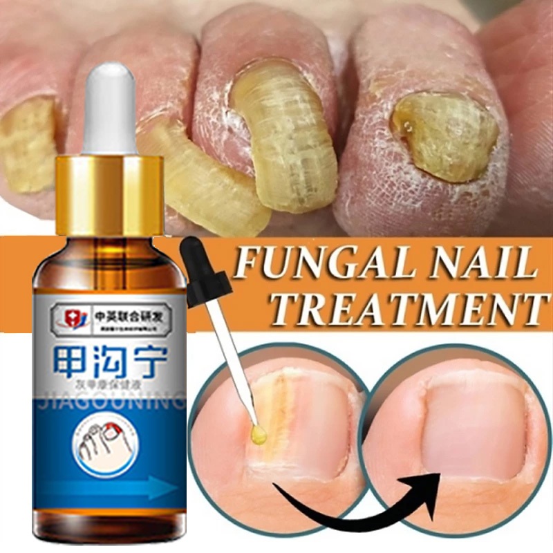 Anti Paronychia Relief Oil Ingrown Toenail Anti Fungal Toe Nail Ingrown ...