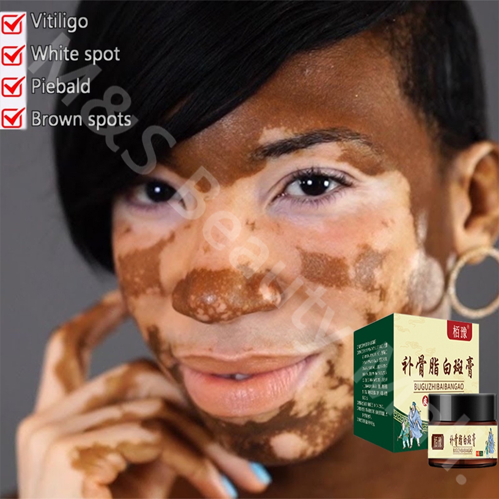 White spot cream 20g Vitiligo White spot treatment Vitiligo treatment ...