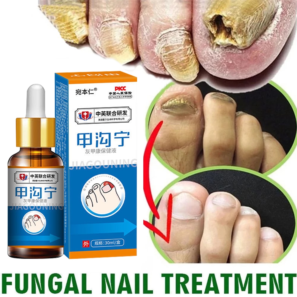 nail fungus treatment30ml Nail repair solution Nail care solution ...