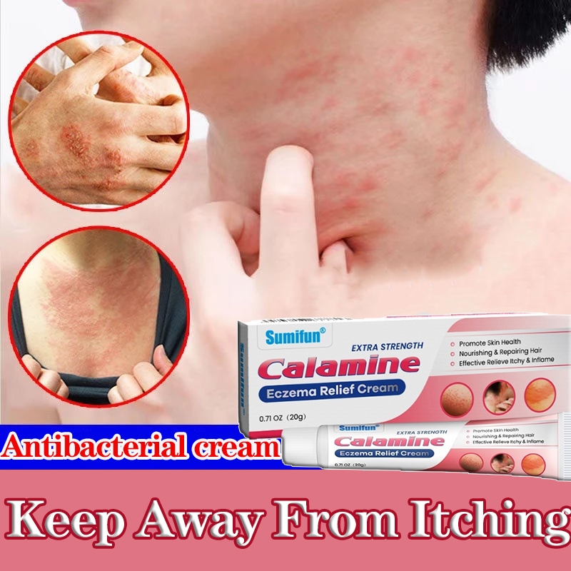 Eczema Anti Itch Cream 20g Calamine Antifungal Cream Psoriasis Ointment ...