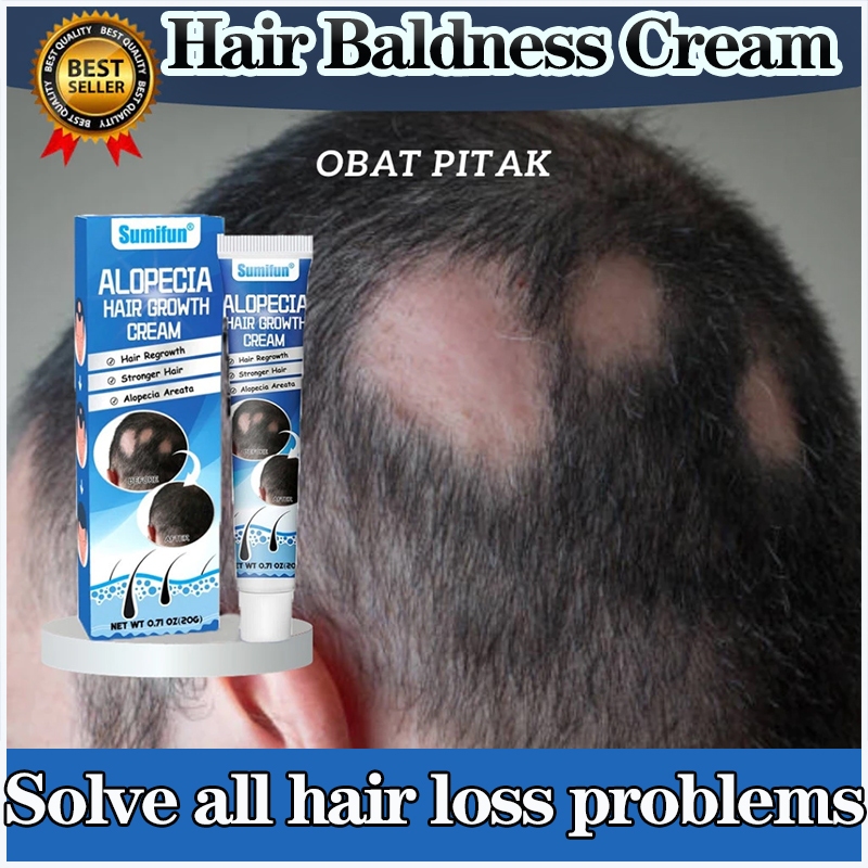 Hair Growth Cream 20g Hair Loss Treatment Alopecia areata ointment ...