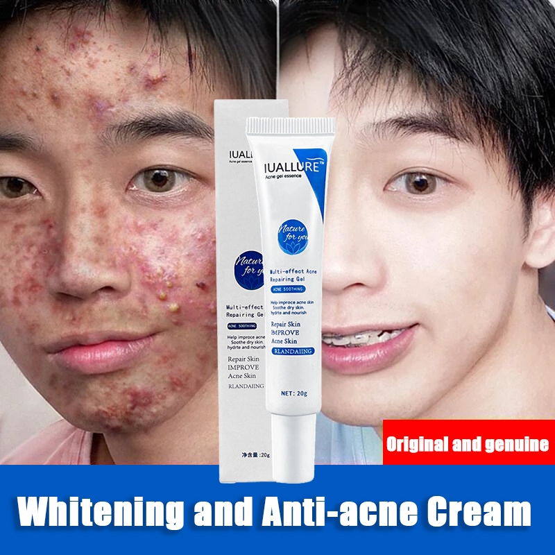 Acne cream, remove acne, for all kinds of acne, acne scars, 20g acne ...