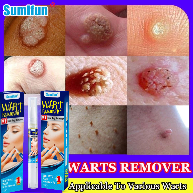 Skin tag remover Wart removal Warts removal cream 4ml mole remover ...