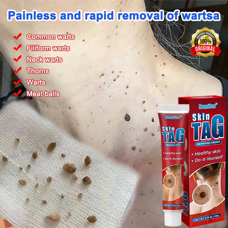 Wart Removal Cream skin tag remover mole remover Foot Warts/Hand Warts ...