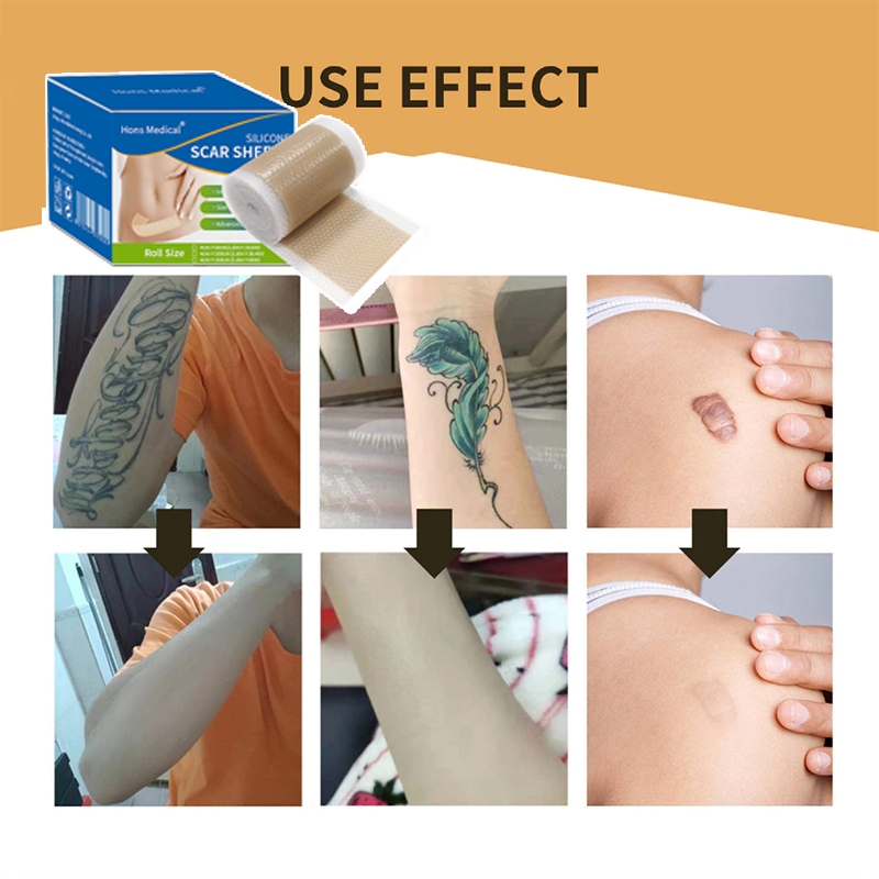 Scar Removal Medical Silicone Scar Sheet 4cmx50cm Scar Gel/Keloid Scar ...