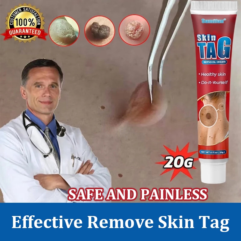 skin tag remover cream wart removal mole removal 20g Natural Herbal ...