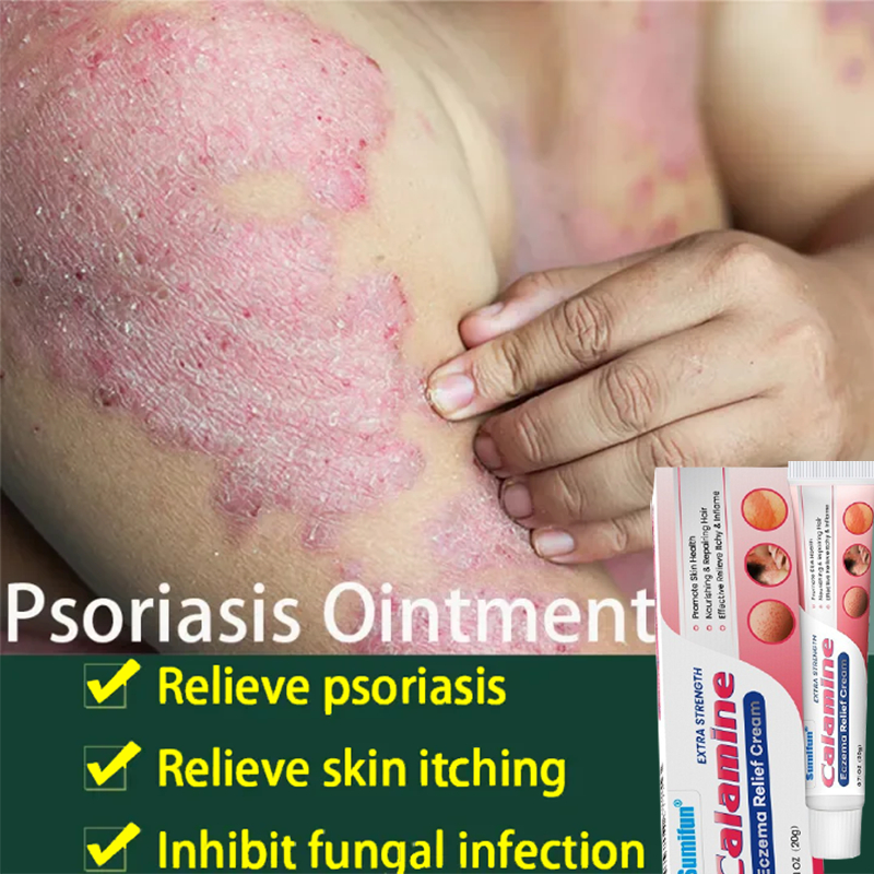 Psoriasis cream Antifungal cream 20g Inhibit fungi/relieve rash ...
