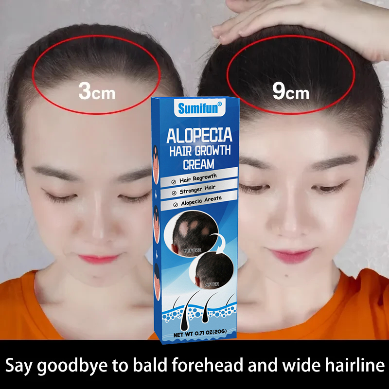 Baldness hairline repair essence hair growth and anti-hair loss ...