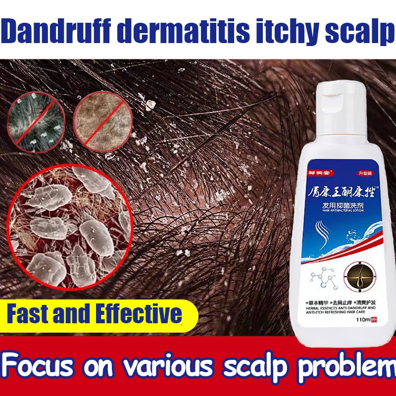 Scalp Treatment Shampoo 110ml dandruff shampoo for oily scalp psoriasis ...
