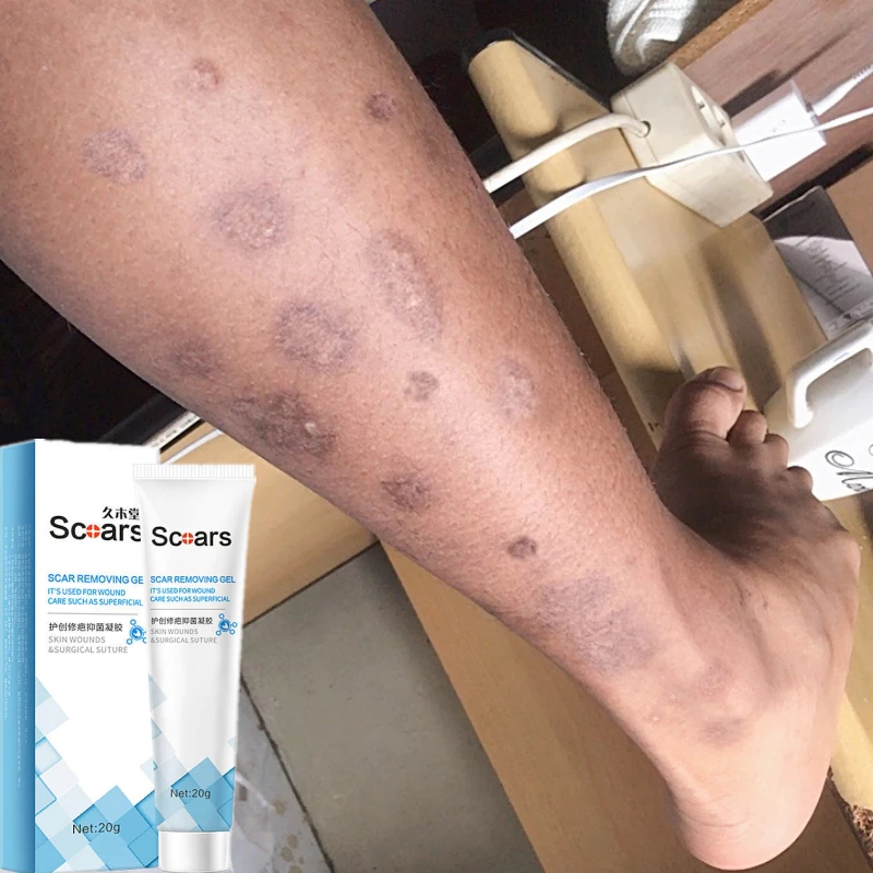 Scar removal cream, repair black scars, hyperplastic scars, surgical ...