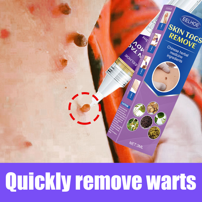 Warts Flat Eliminate Wart Pen Wart Liquid Hand Foot Warts Remove ...
