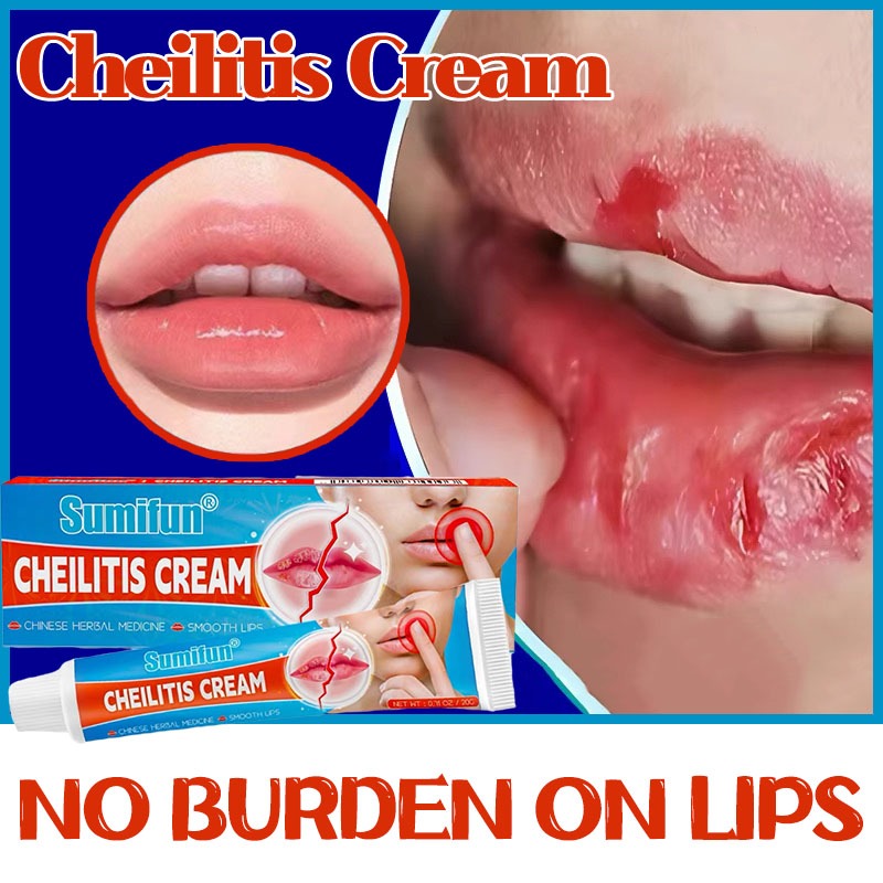 Lip Treatment Cheilitis Cream 20g Cold Sore Treatment Lips Herpes Cream Medicated Lip Care For ...