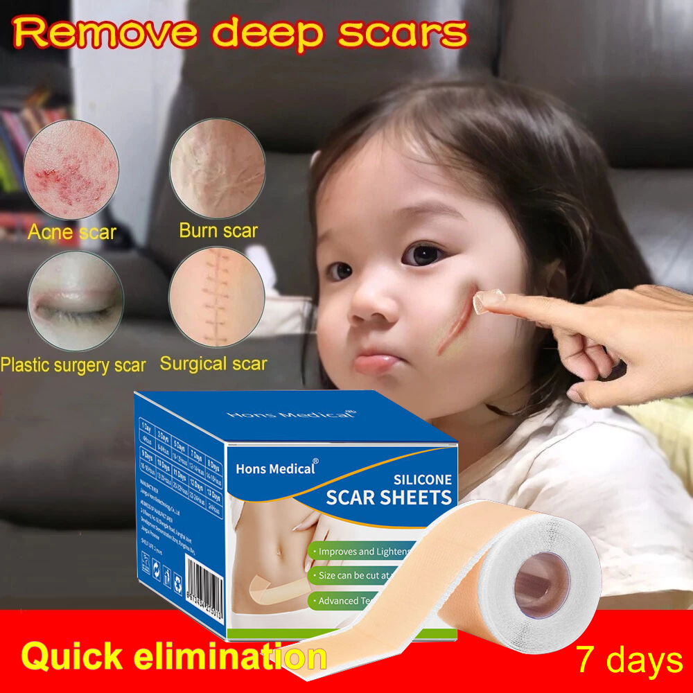 Scar Removal Medical Silicone Scar Sheet 4cmx50cm Scar Gel/Keloid Scar ...