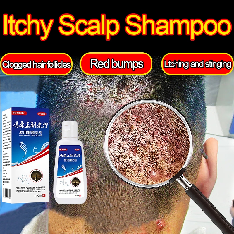 ketoconazole shampoo Itchy Scalp Shampoo 110ml Ketoconazole Shampoo ...