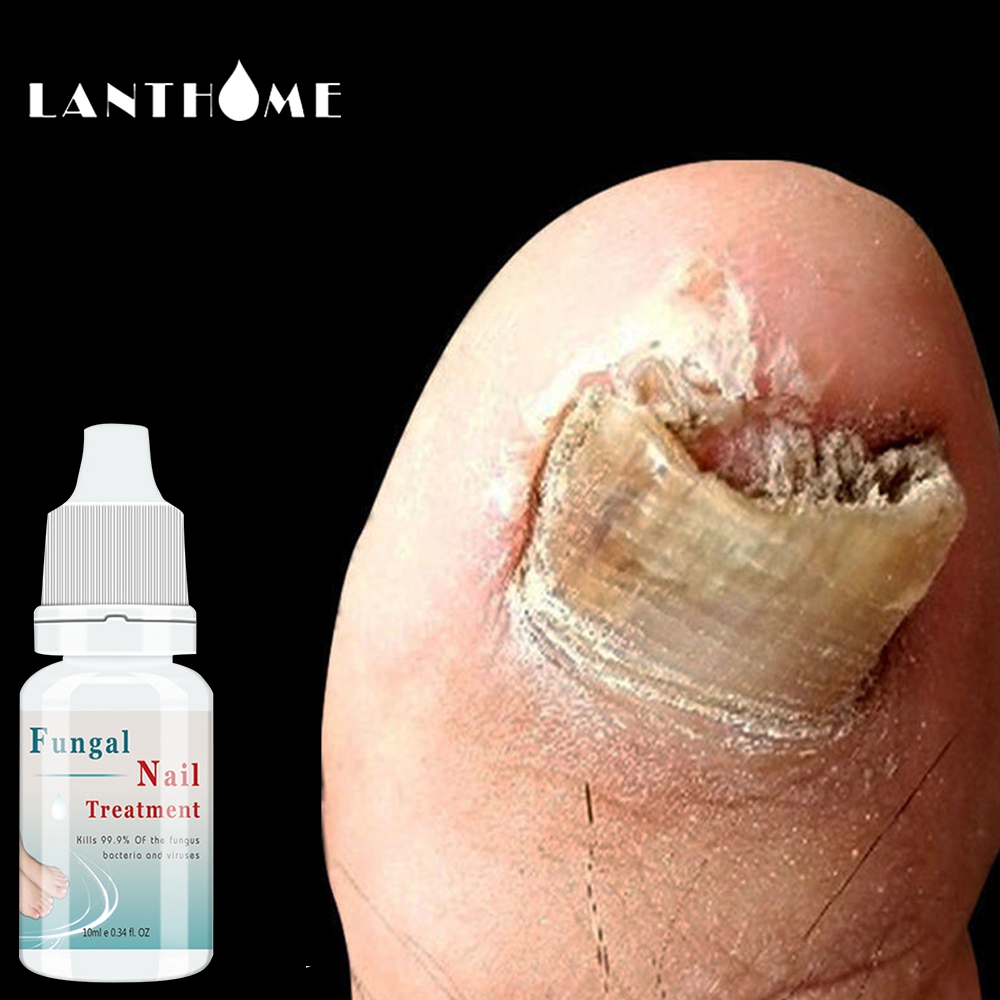 lanthome nail treatment fungal anti fungal for nails Fungal Nail ...