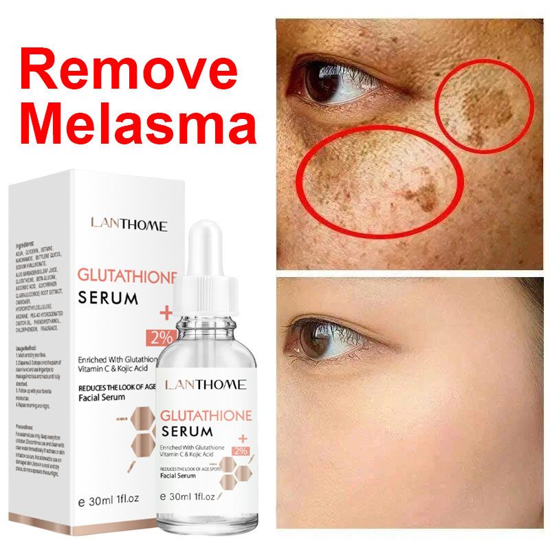 Glutathione Effective Remove Melasma/Dark Spot Pigmentation Remove ...