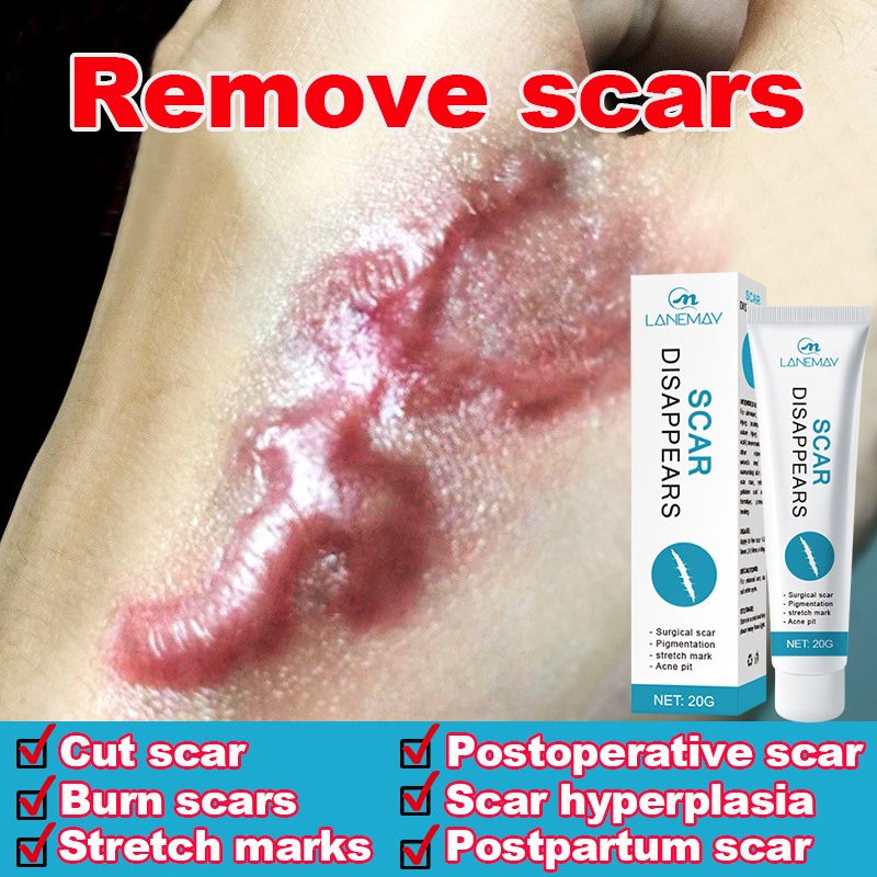 scar removal cream scar gel 20g removal keloid lightening melanin scar ...
