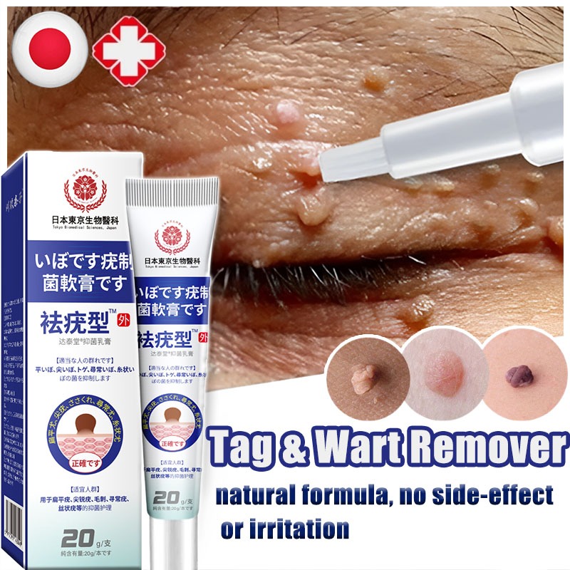 【Medical】Wart Removal Cream 20g Mole Skin Tag Remover Painless Genital ...