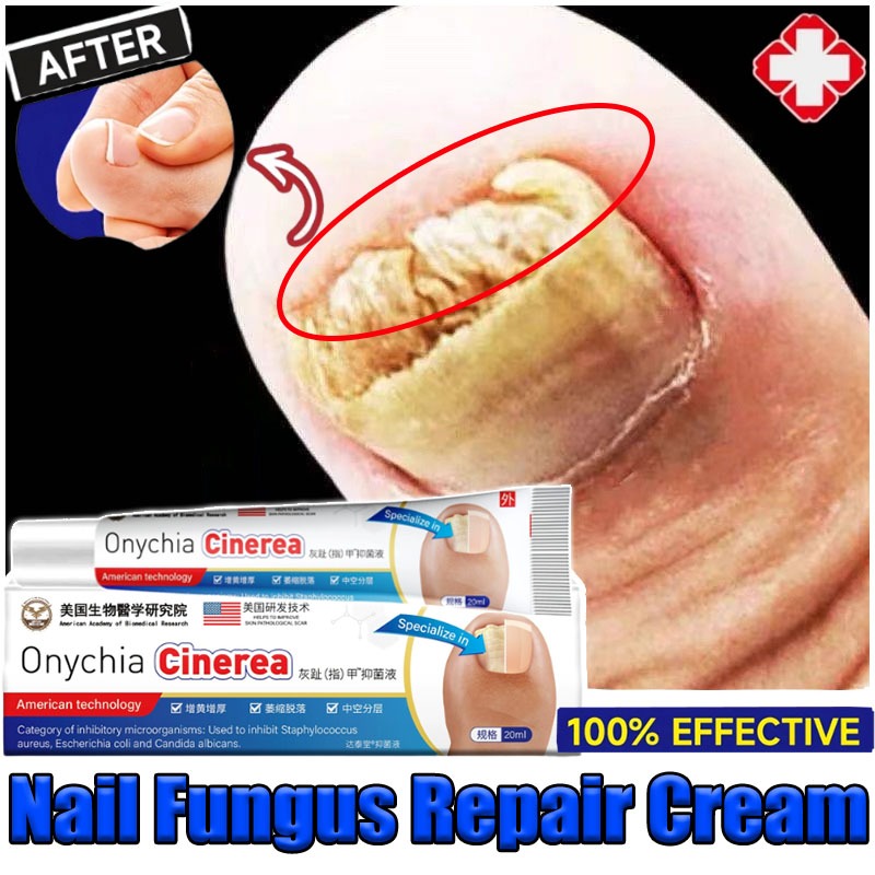 [US. R&D] Nail Fungus Treatment 20ml Antibacterial Nail Repair Cream ...