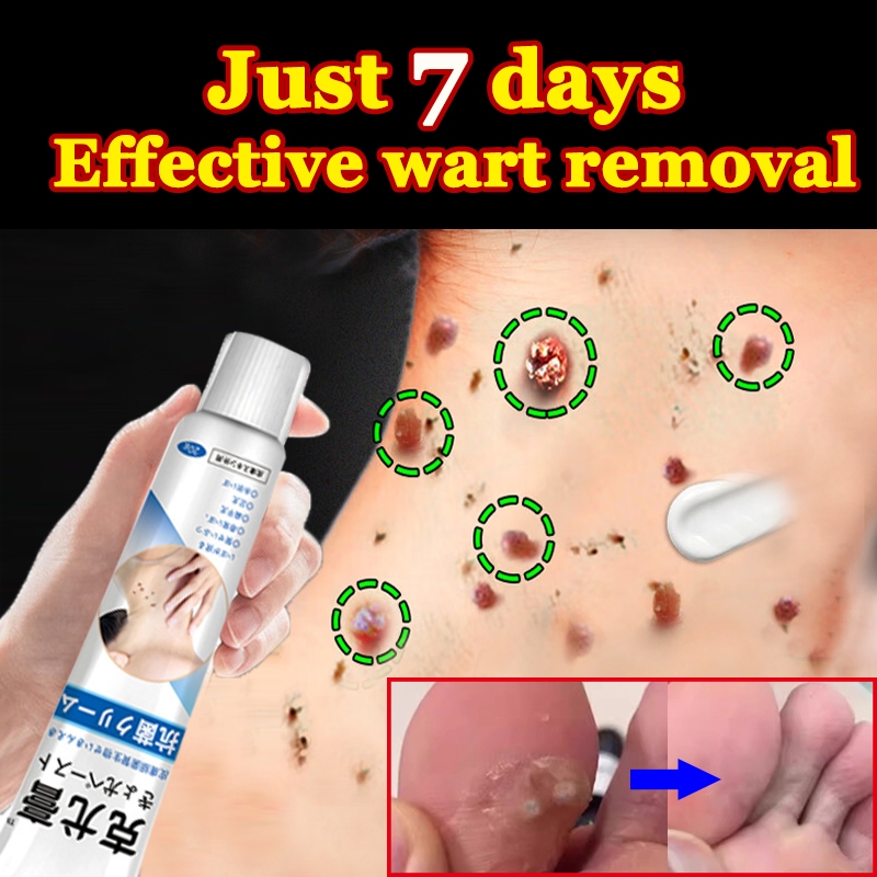 Skin Tags Remover Mole Removal Warts Removal Cream 20g Flat Warts Small ...