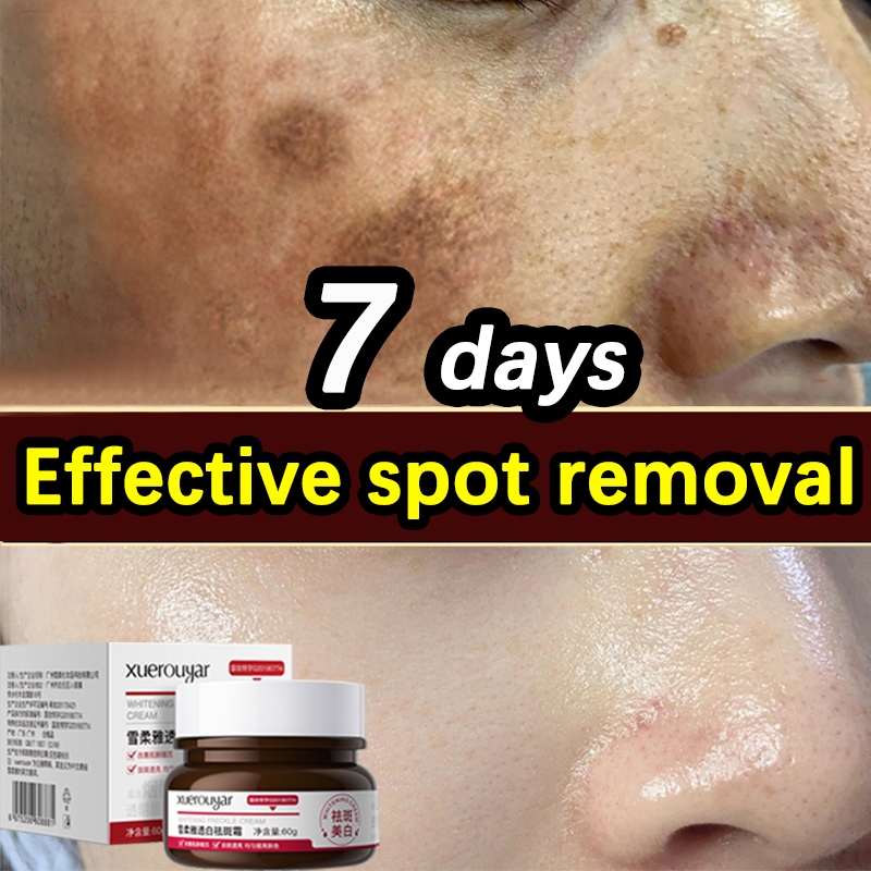 Melasma Cream Freckles Removal Cream 60g Dark Spot Remover Reduces ...