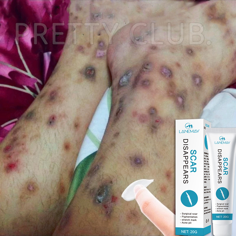 Scar Removal Cream Keloid Scar Gel Acne Scar Removal Mosquito Bite Scar ...