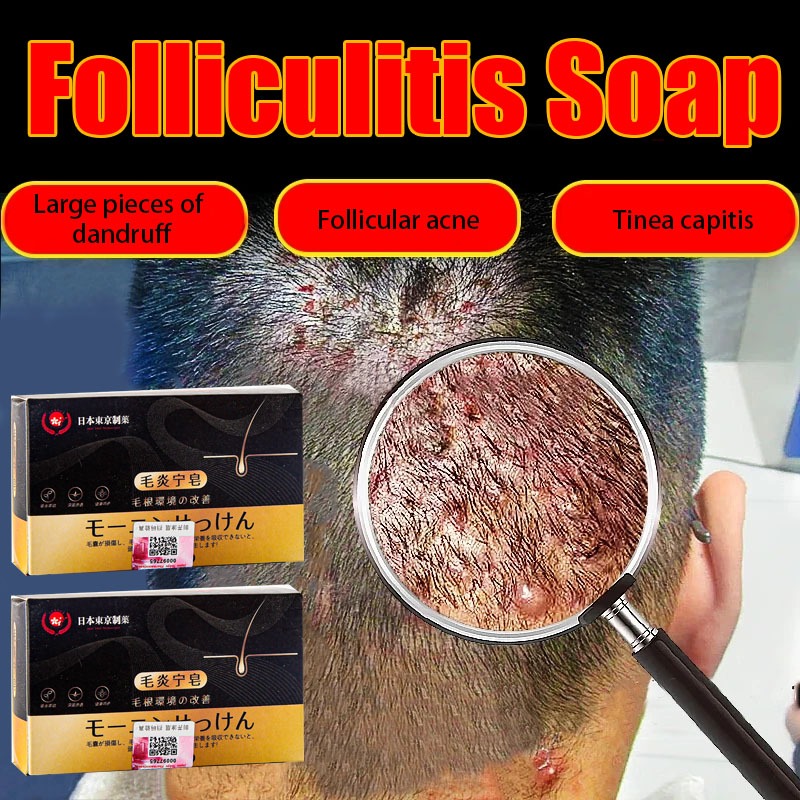 Scalp Treatment Soap 85g Seborrheic folliculitis Dandruff Acne ...