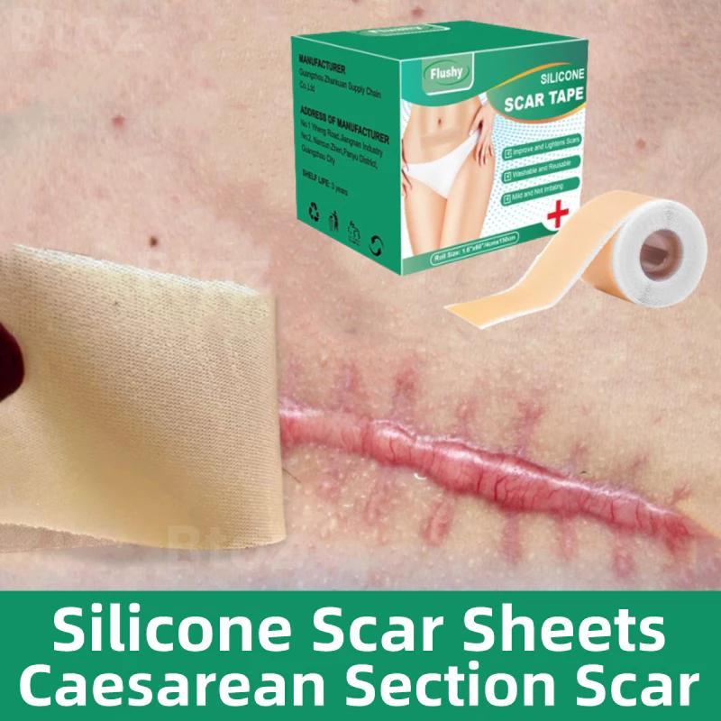 Silicone scar sheet Surgery Scar Removal Penghilang Bekas Luka ...