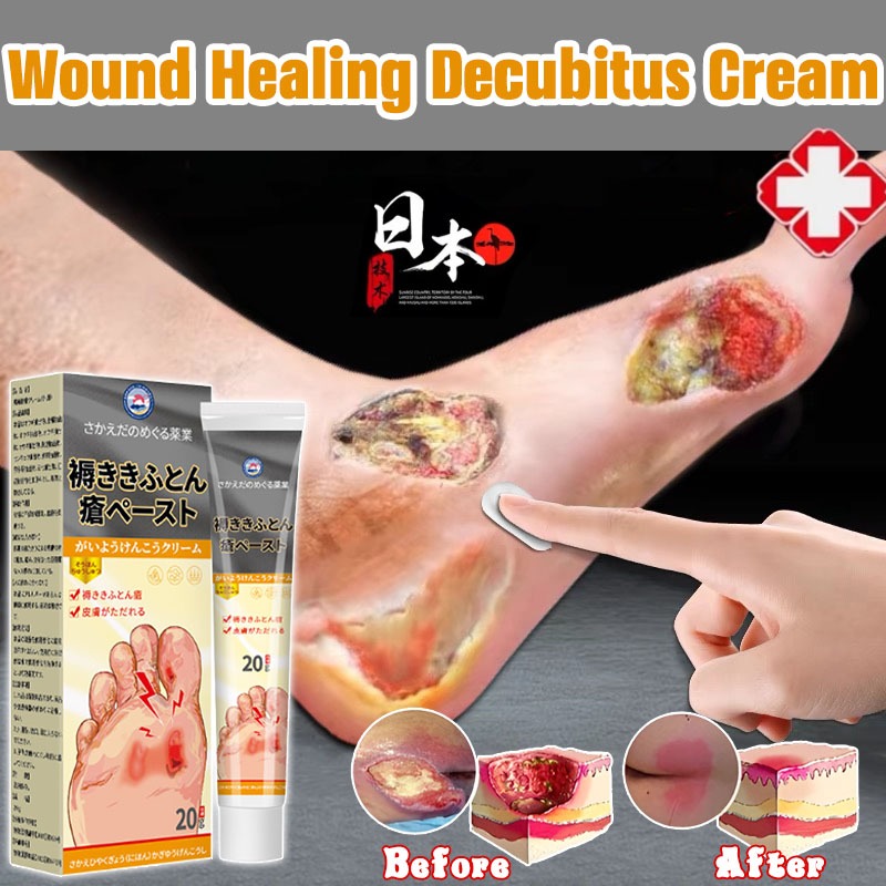 Japan Bedsore Cream 20g Wound Healing Decubitus Feet Care Ointment ...